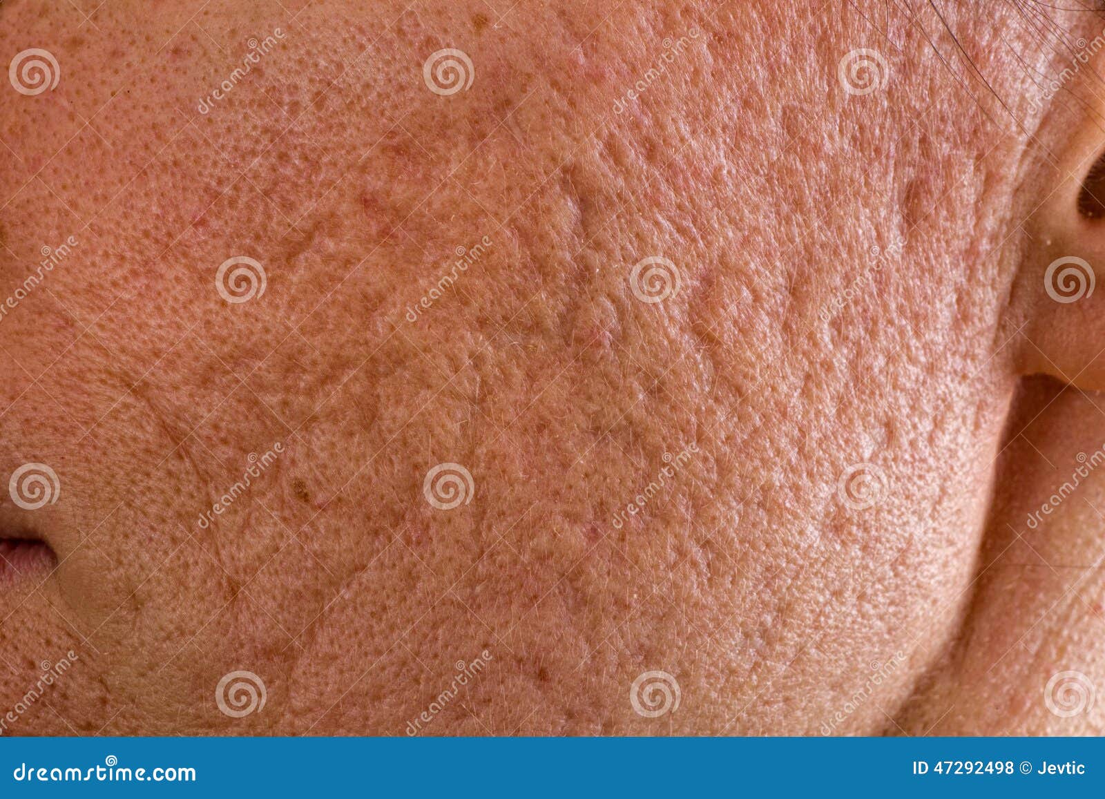 Acne scars on cheek stock photo. Image of cheek, face - 47292498