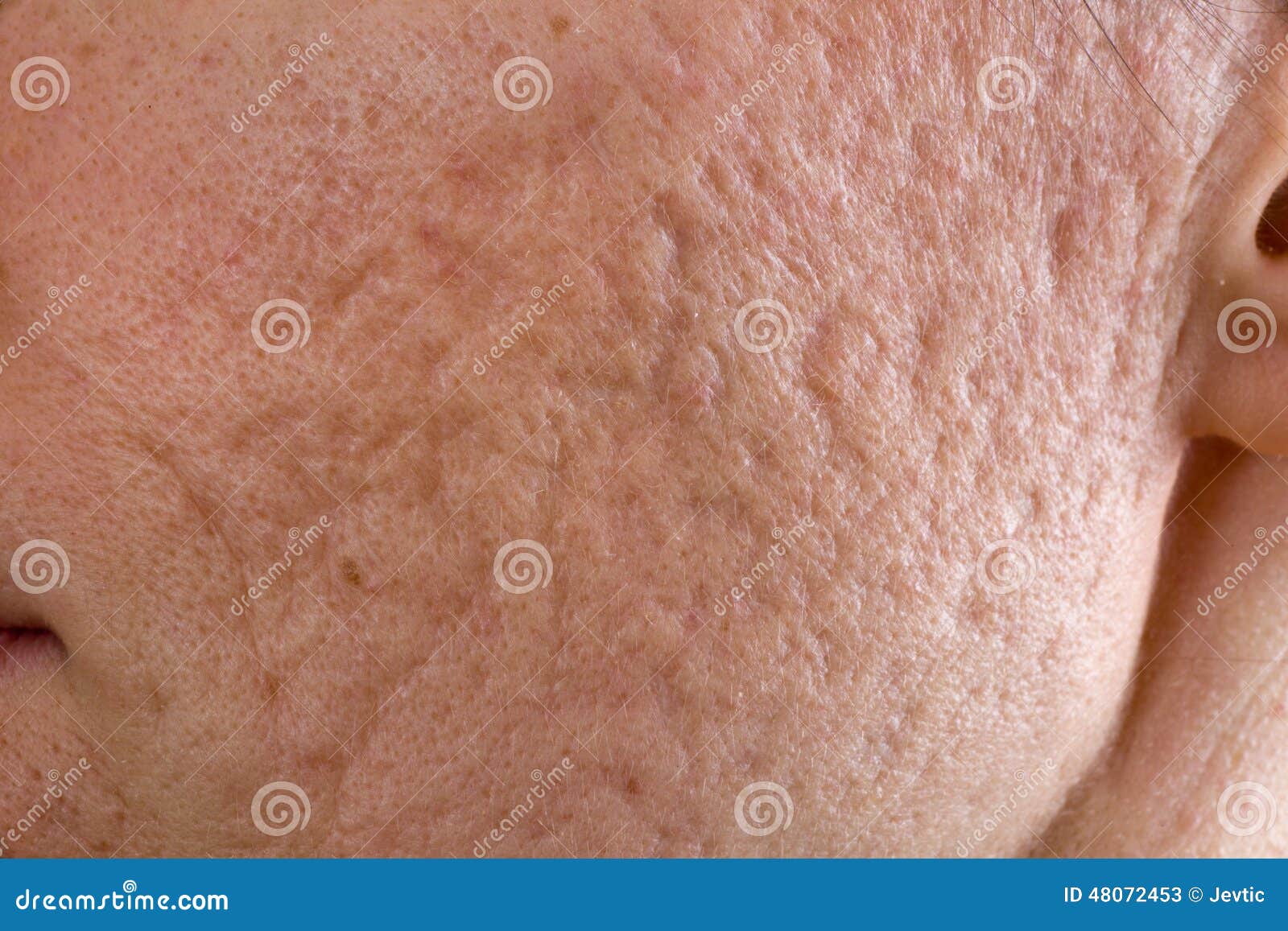 Acne scars on cheek stock image. Image of cheek, pimples - 48072453
