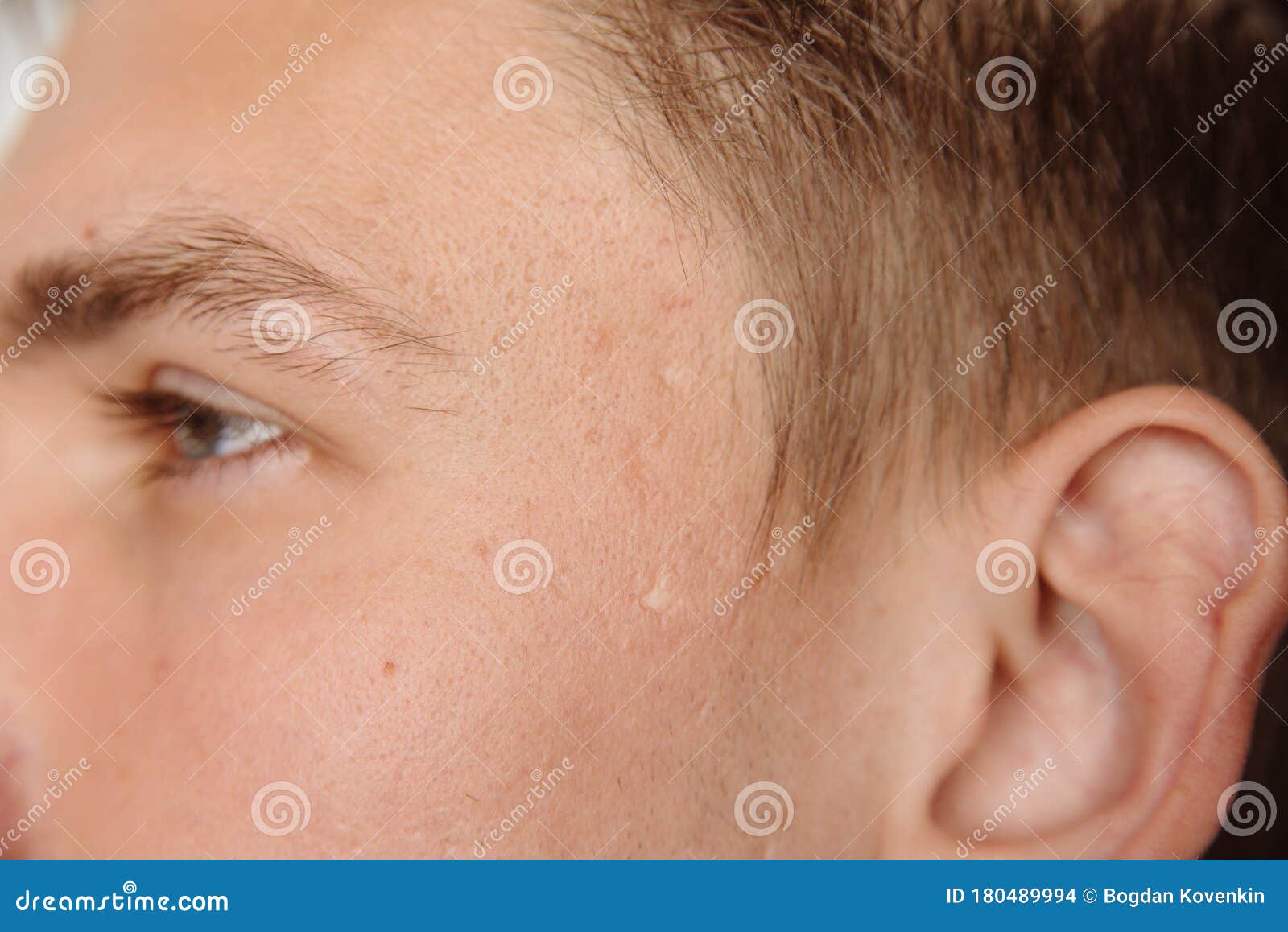 Acne scars on the face stock photo. Image of melanoma - 180489994