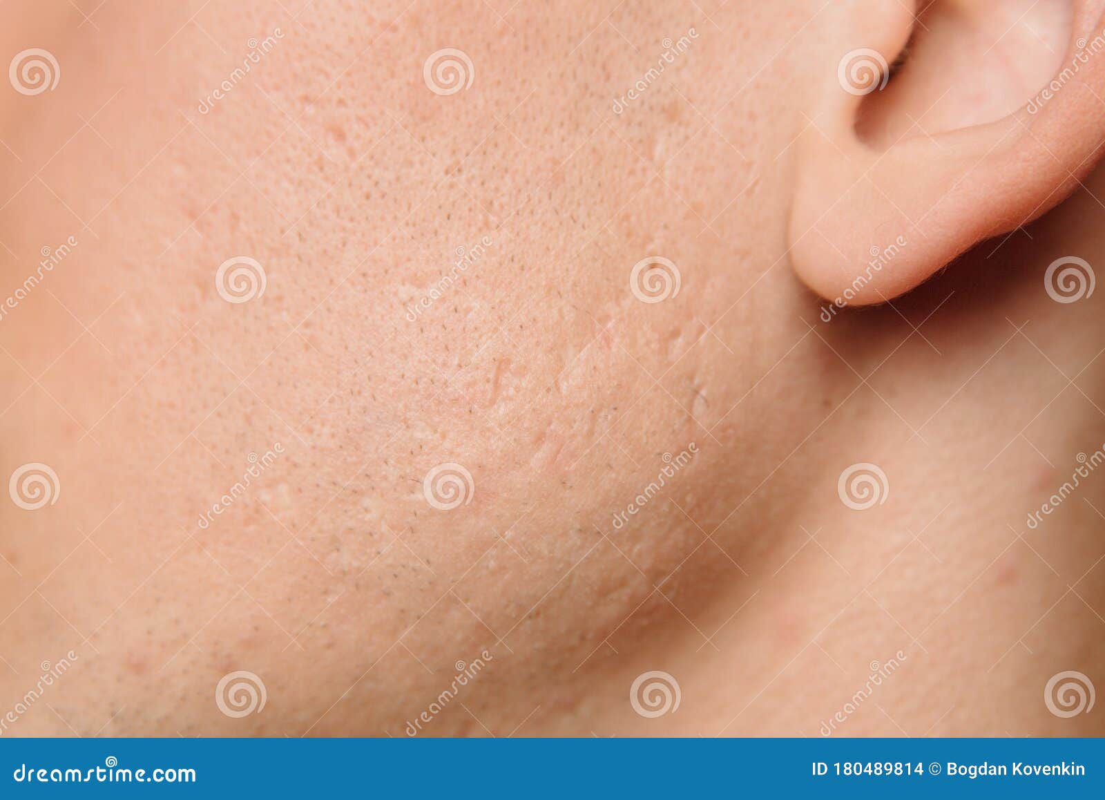 Acne scars on the face stock photo. Image of melanoma - 180489814