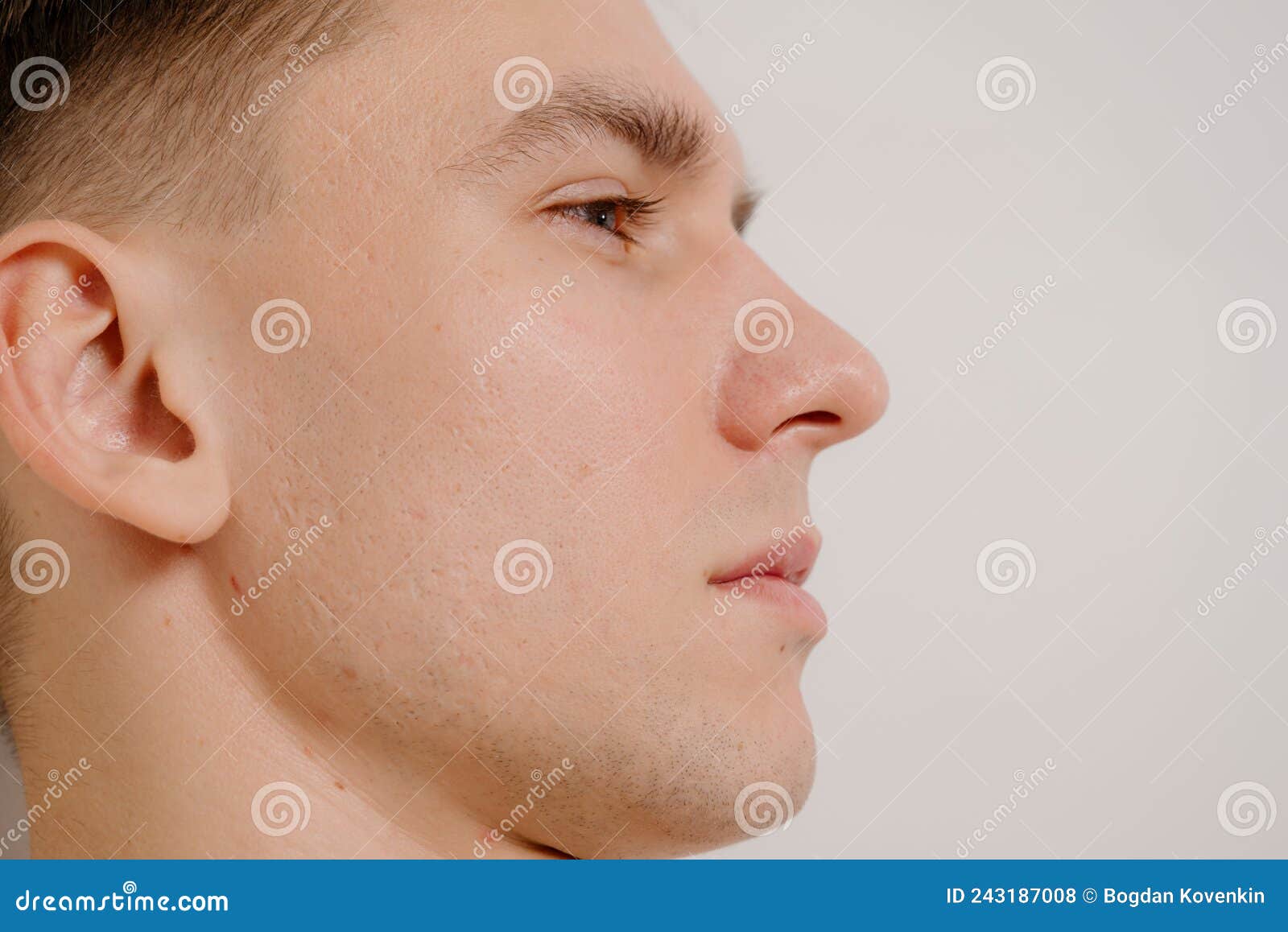 Acne scars on the face stock photo. Image of melanoma - 243187008