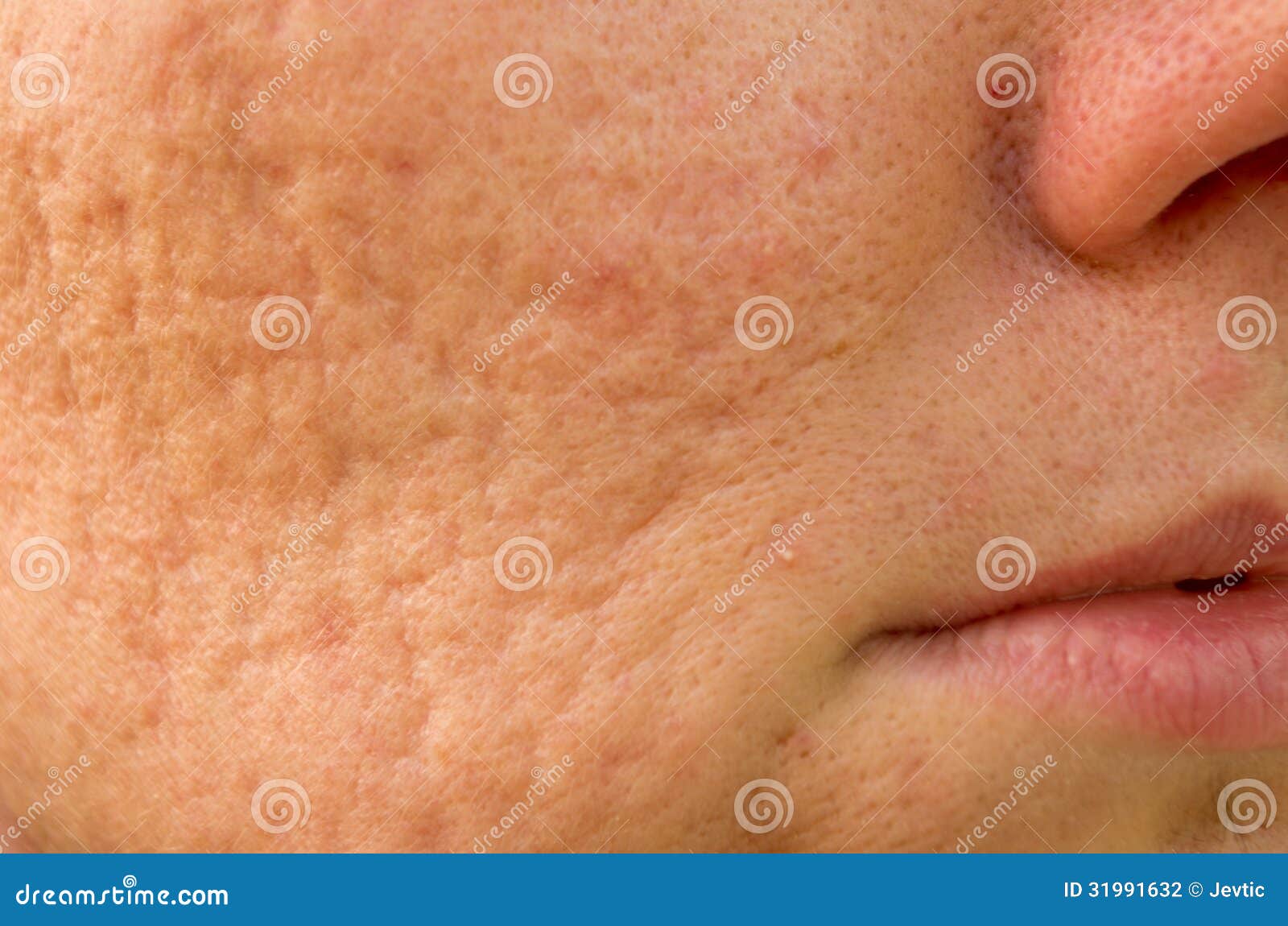 Acne scars stock photo. Image of infection, complexion - 31991632