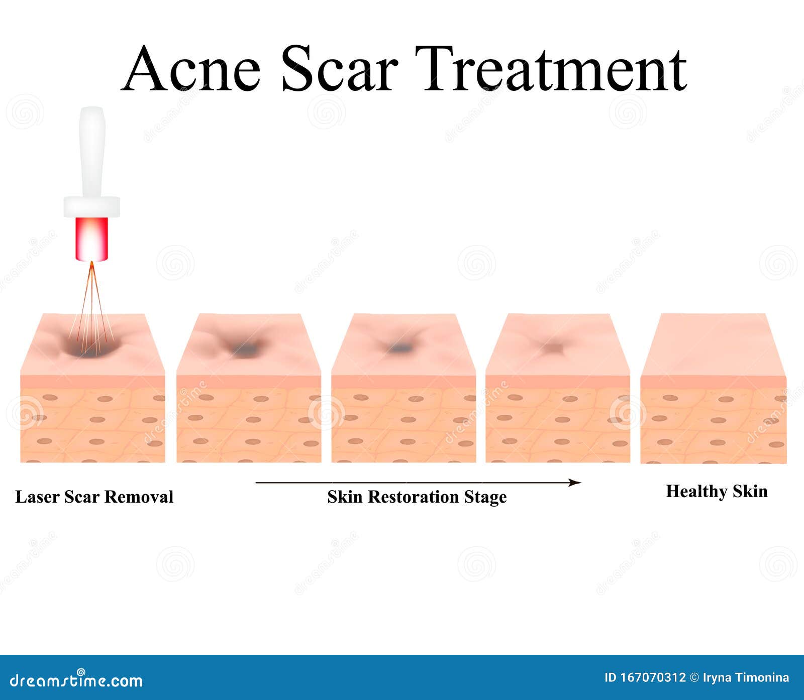 Acne Scars Laser Scar Atrophic Treatment The Anatomical Structure Of