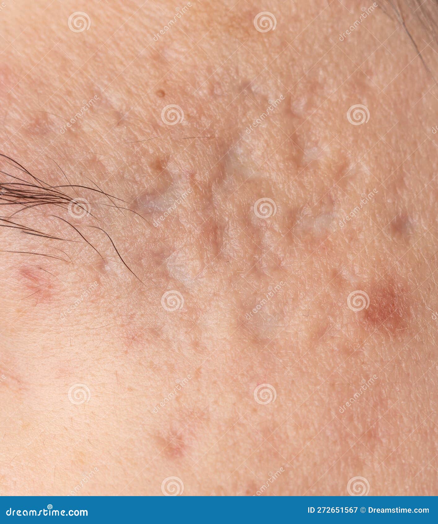 Acne Scars on the Skin. Macro Stock Image - Image of blemish, healthy ...