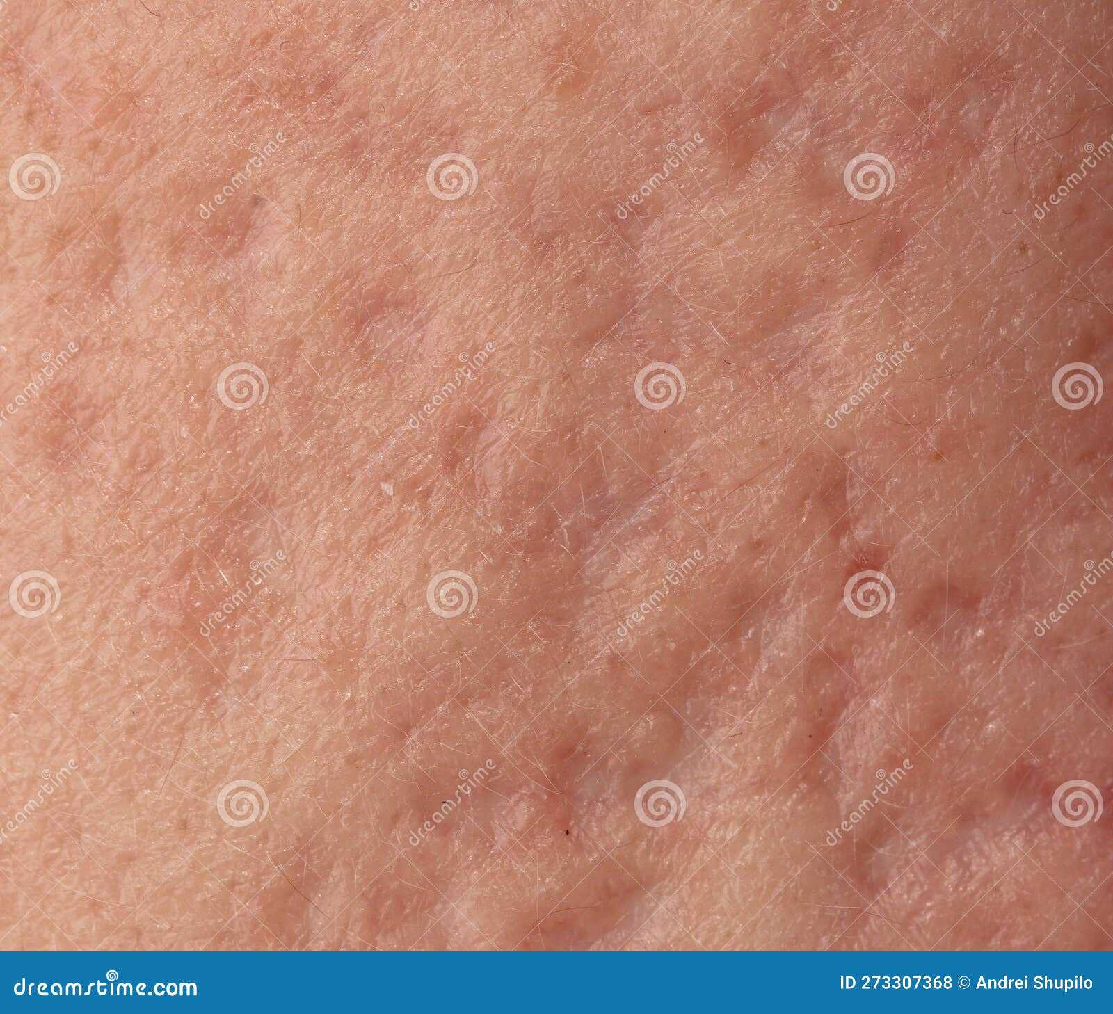Acne Scars on the Skin. Macro Stock Photo - Image of scar, dermatology ...