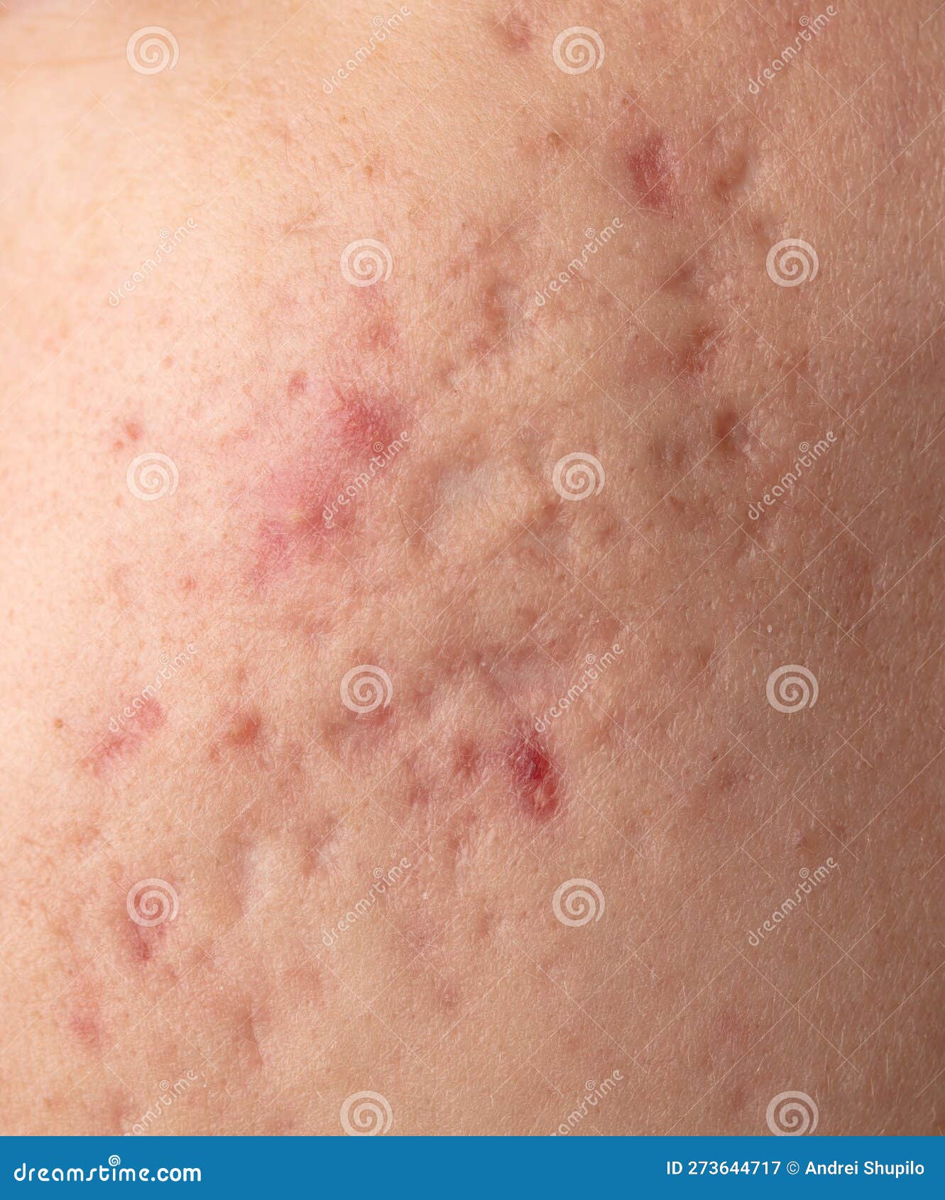 Acne Scars on the Skin. Macro Stock Image - Image of texture, scars ...