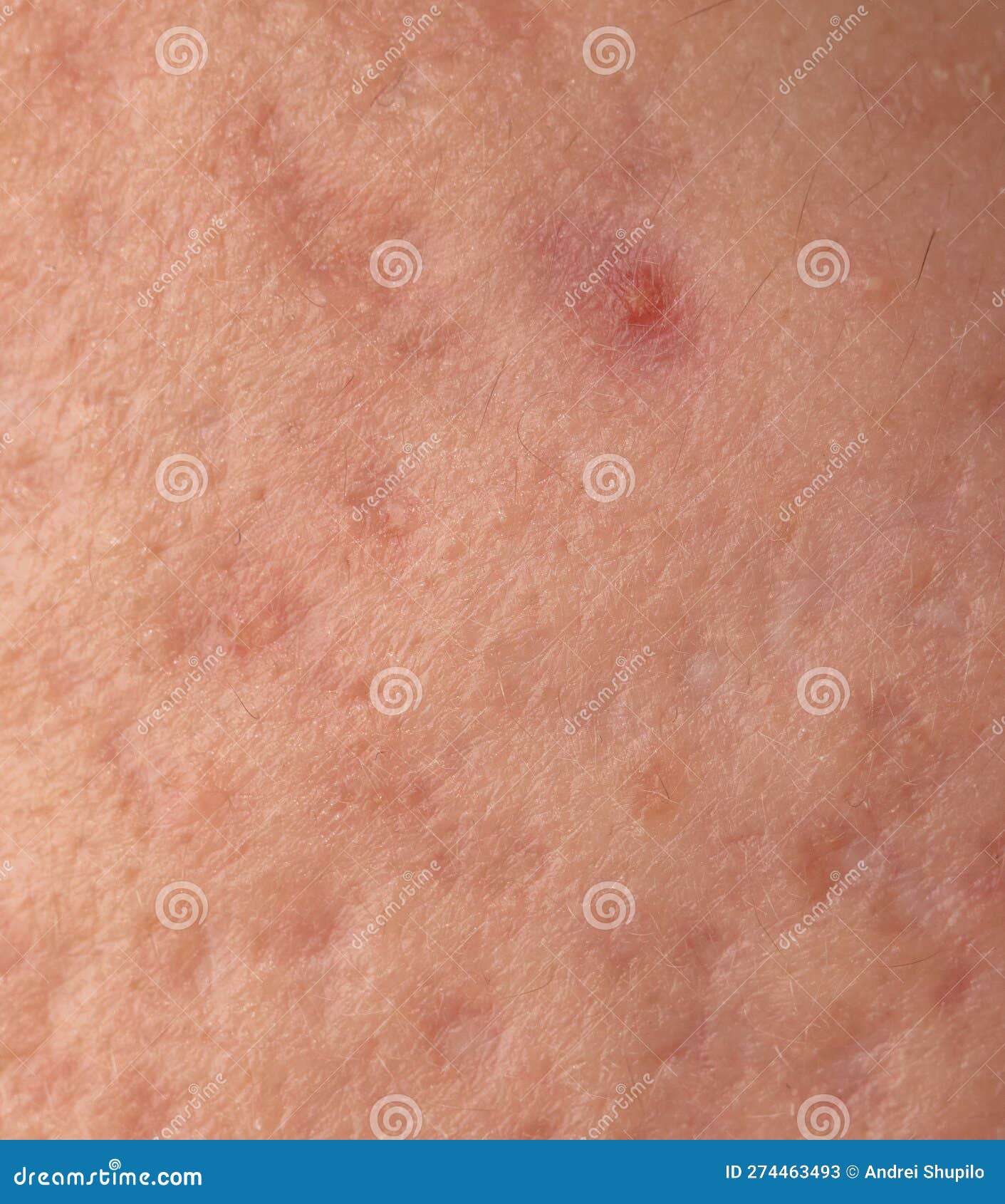 Acne Scars on the Skin. Macro Stock Image - Image of adolescence, macro ...