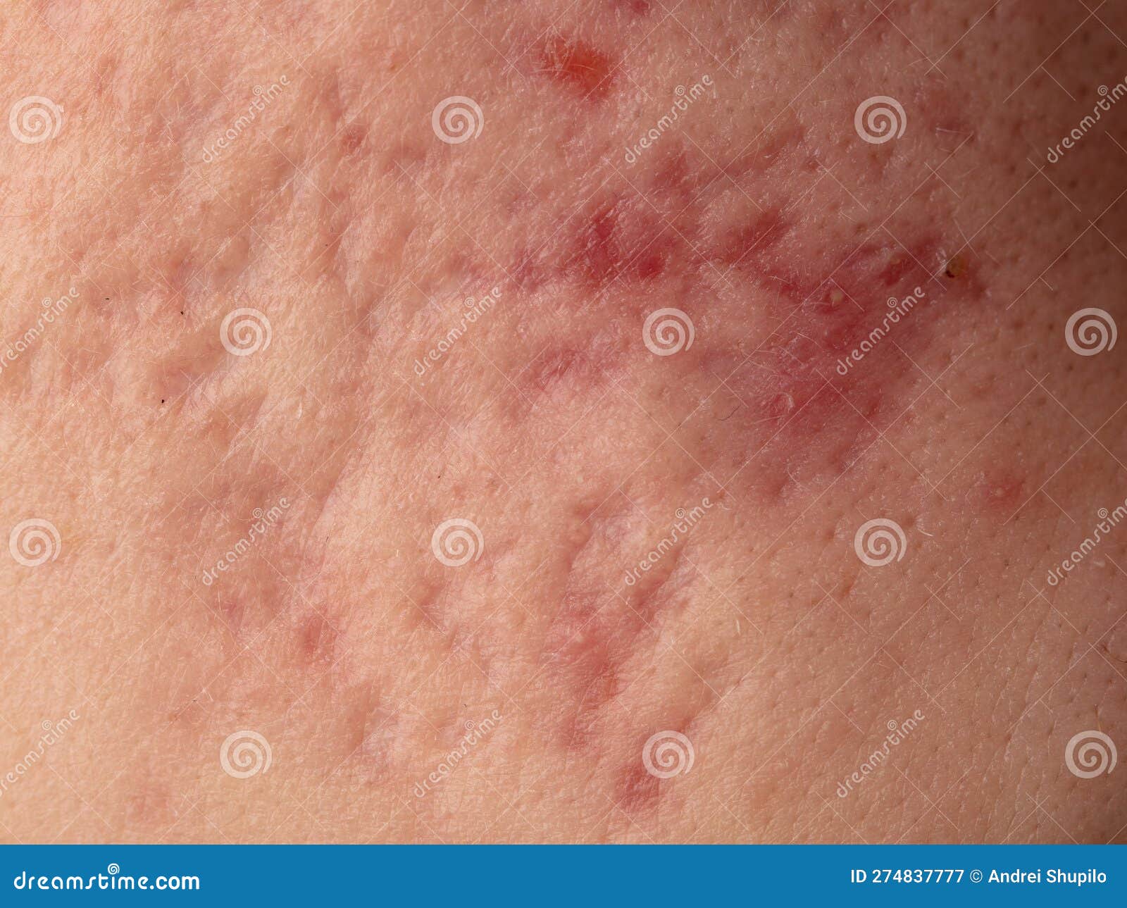 Acne Scars on the Skin. Macro Stock Image - Image of skin, disease ...