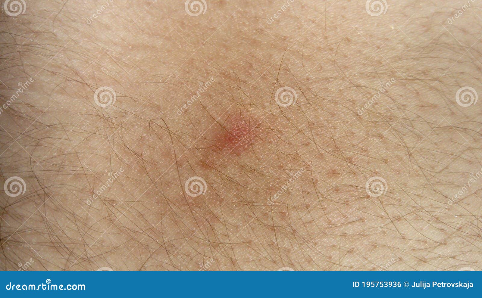 Acne. a Single Boil in the Thickness of the Skin Stock Photo - Image of ...