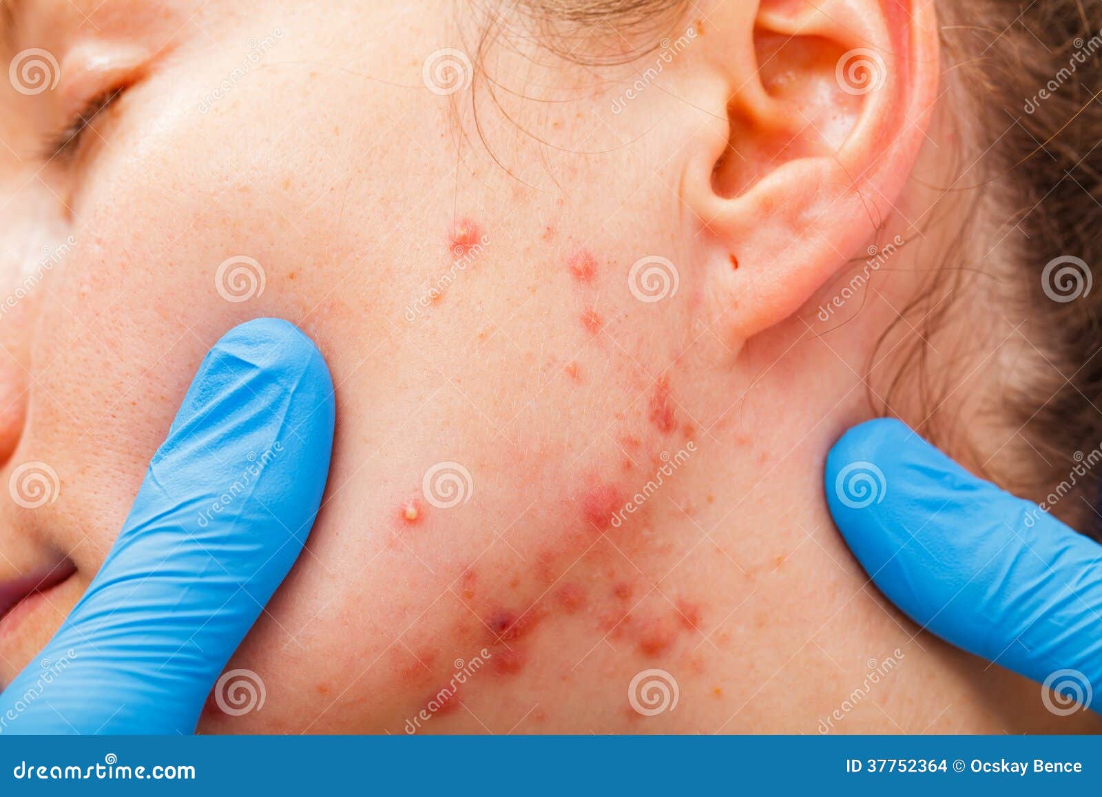Acne. Papules. Young Woman Face With Skin Inflammation. Close-up View ...