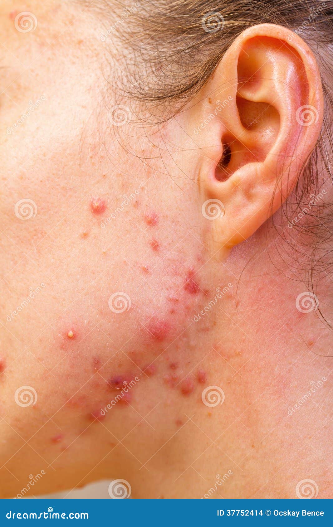 Acne. Papules. Young Woman Face With Skin Inflammation. Close-up View ...