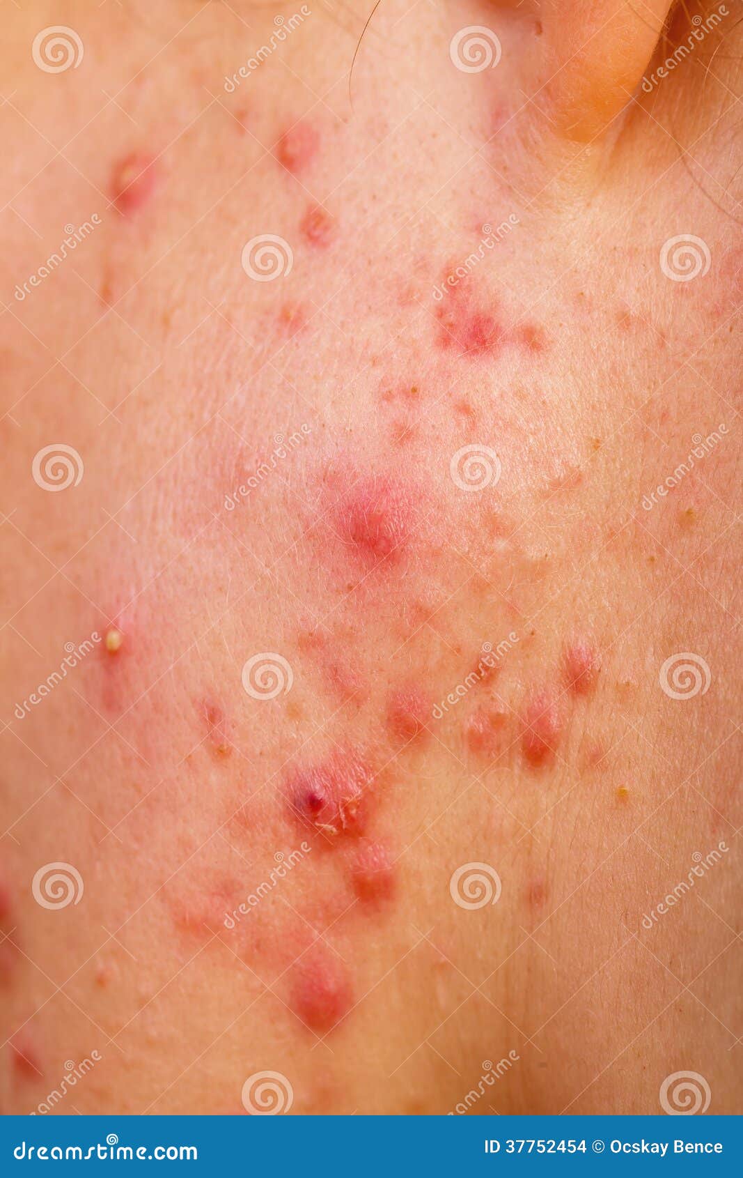 Acne skin stock photo. Image of infection, glands, eruption - 37752454