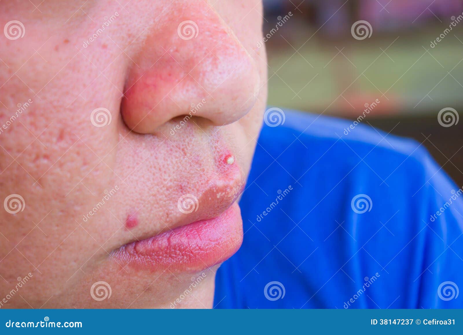 Acne skin stock image. Image of lesion, cystic, painful - 38147237