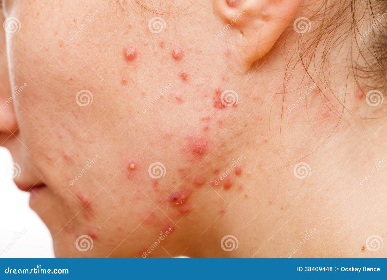 Acne. Papules. Young Woman Face With Skin Inflammation. Close-up View ...