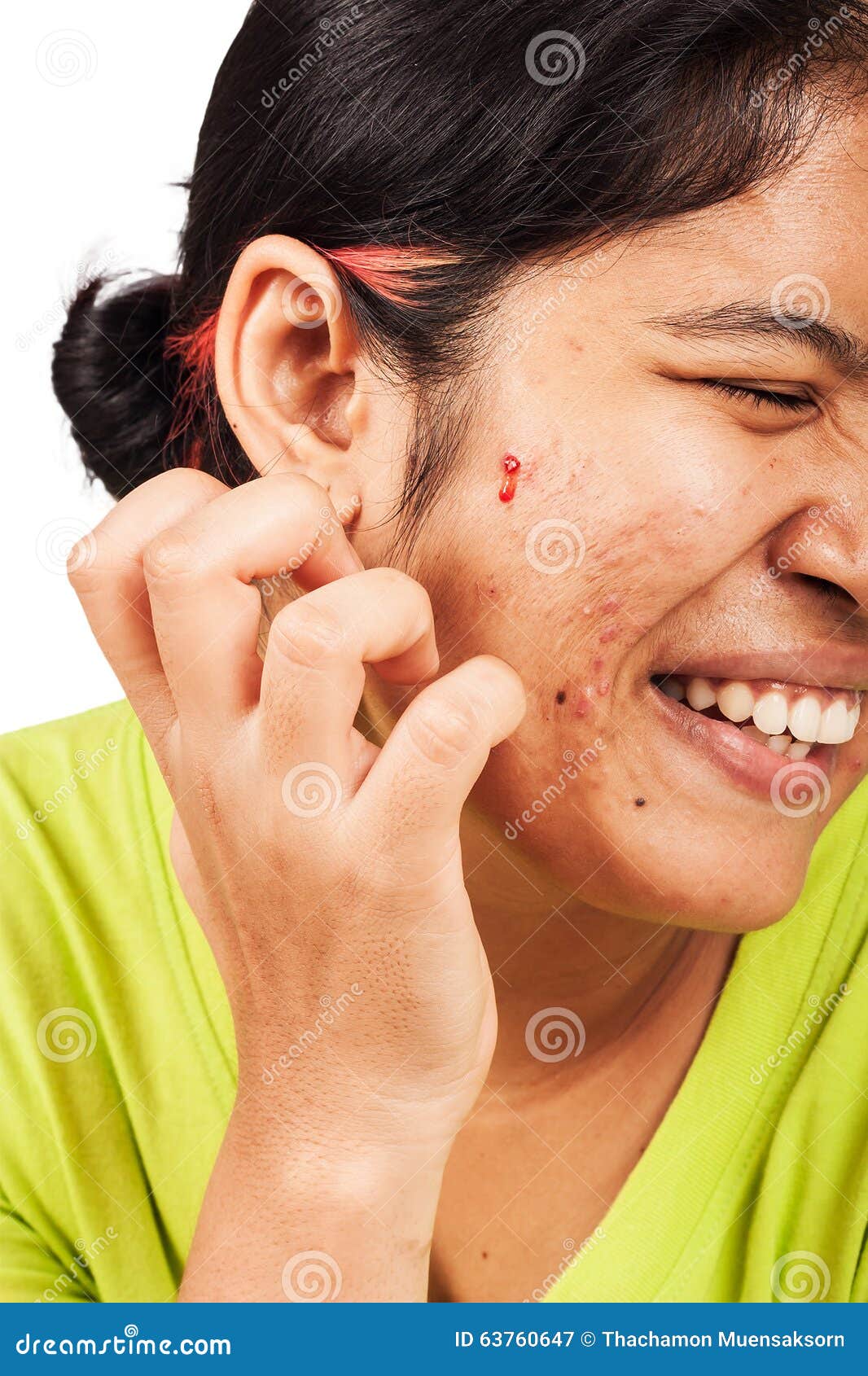 Acne on skin face stock image. Image of head, infection - 63760647