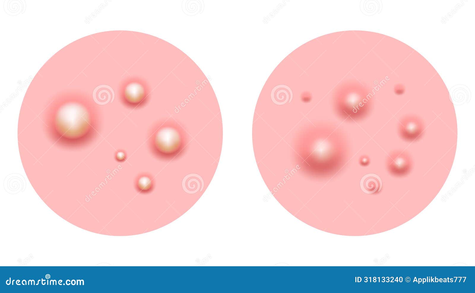 Acne Skin Pimple, Vector Illustration Stock Vector - Illustration of ...