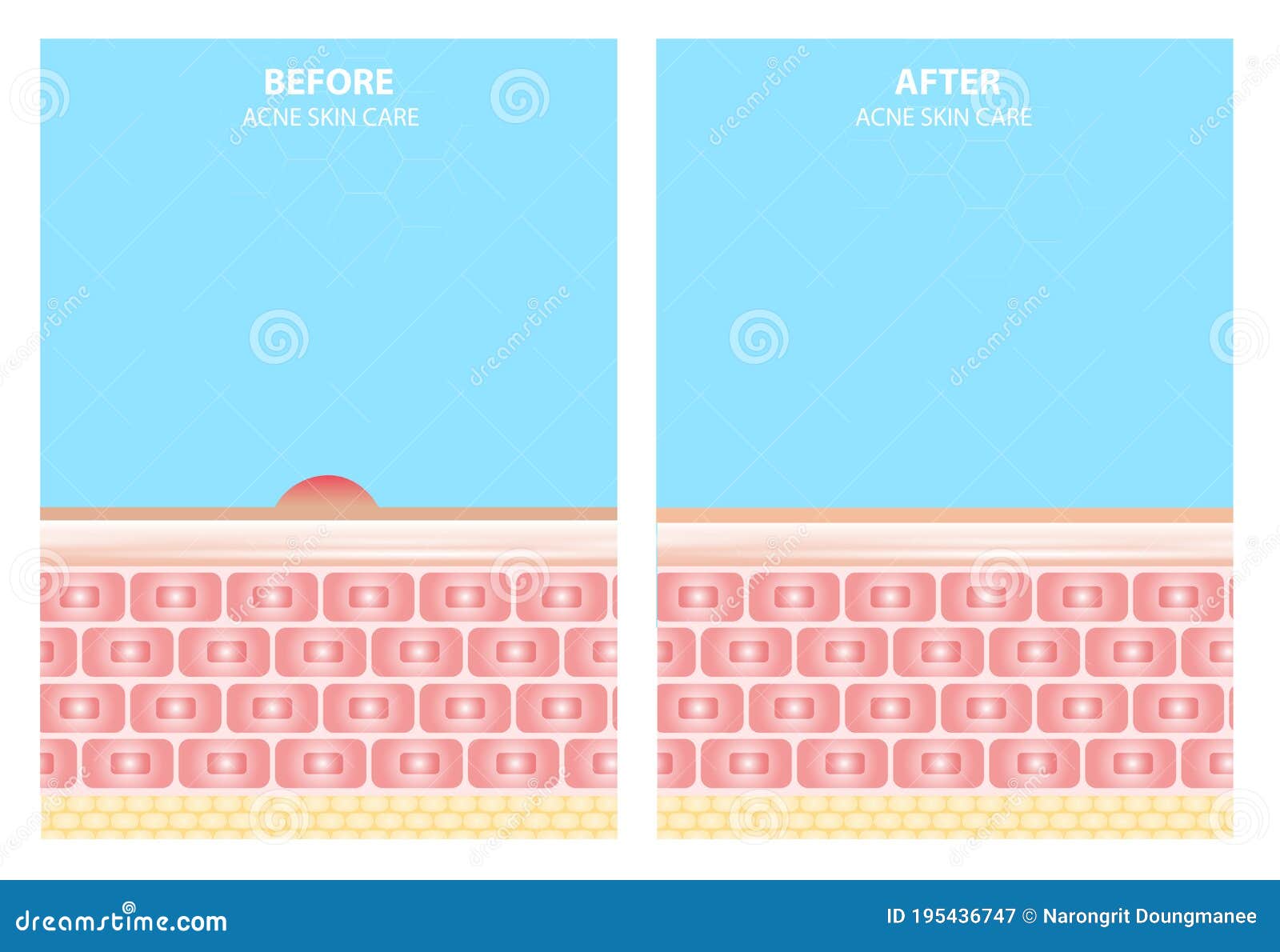 Acne Skin Spot Pimple Problem Vector Design Stock Vector - Illustration ...