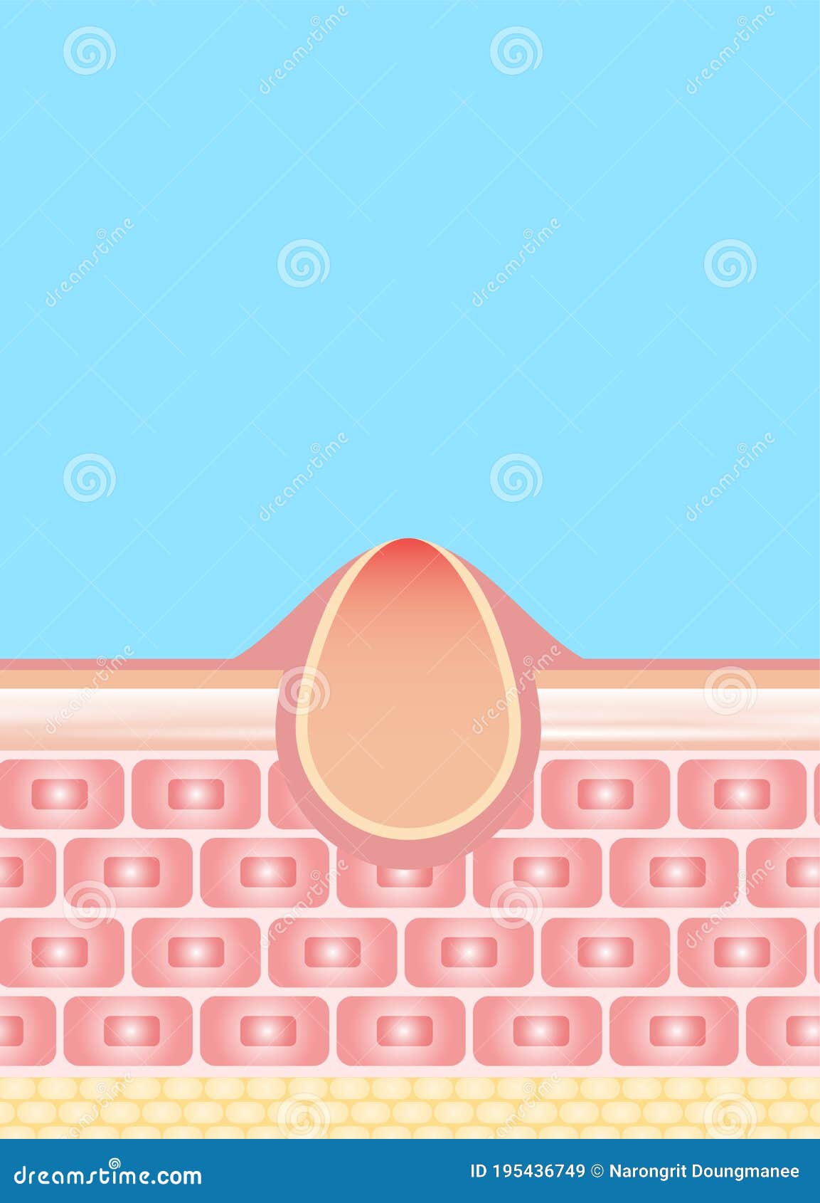 Acne Skin Spot Pimple Problem Vector Design Stock Vector - Illustration ...