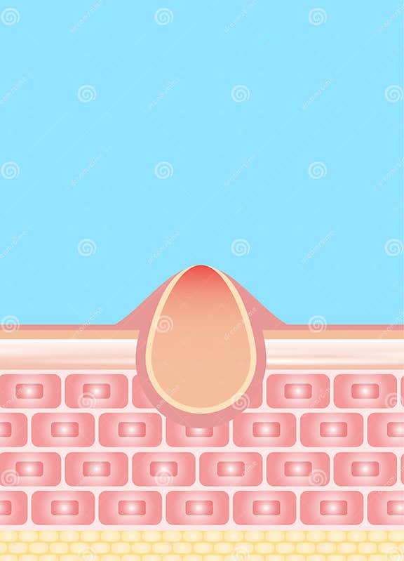 Acne Skin Spot Pimple Problem Vector Design Stock Vector - Illustration ...