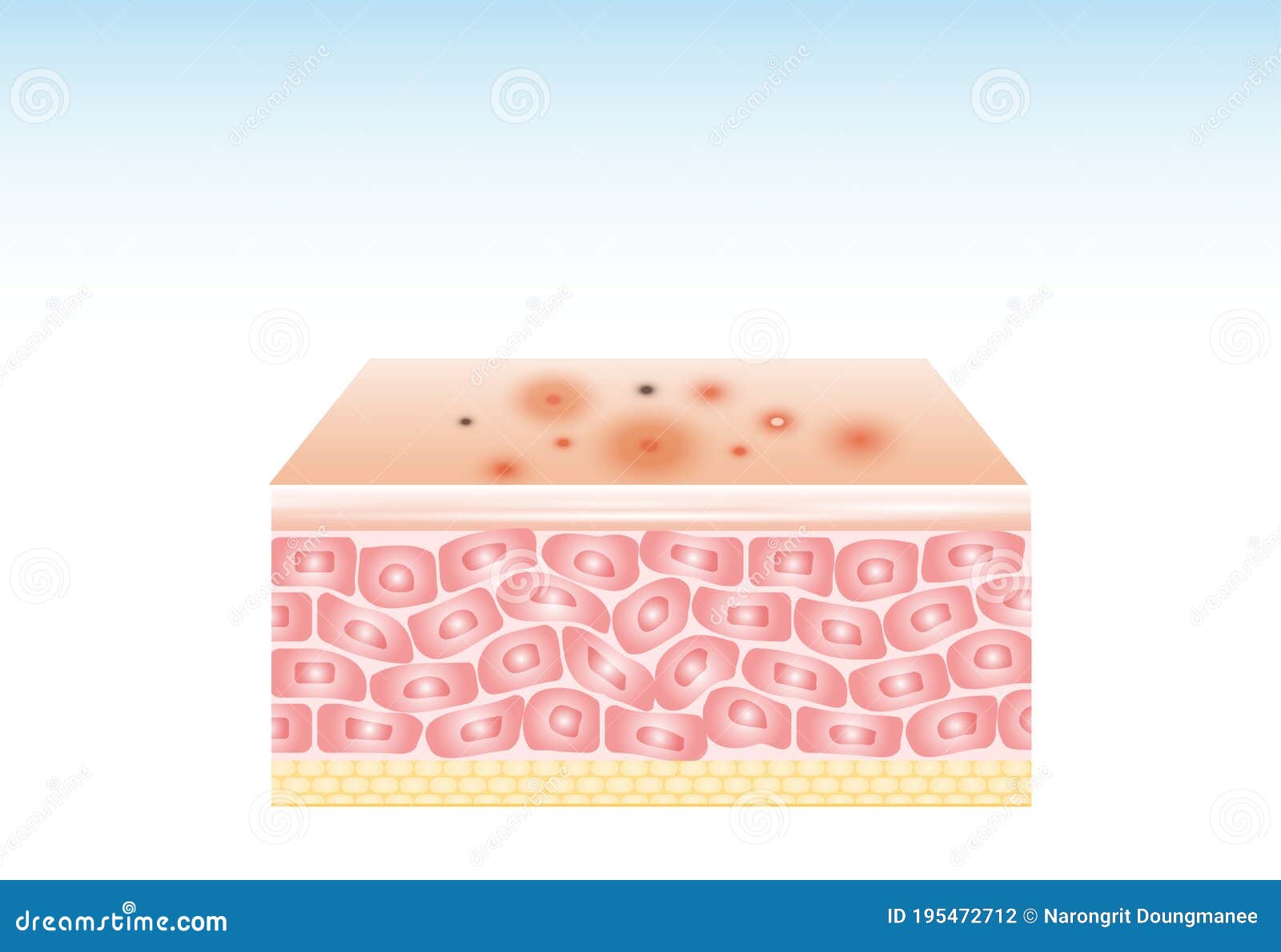Acne Skin Spot Pimple Problem Vector Design Stock Vector - Illustration ...