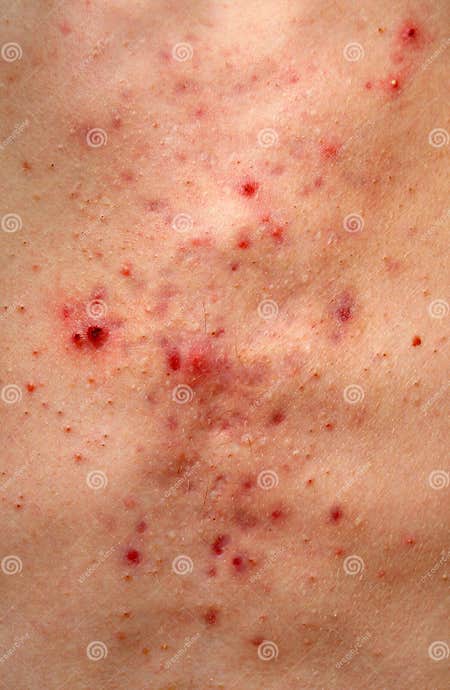 Acne Skin Texture stock photo. Image of complexion, bacillus - 12499106