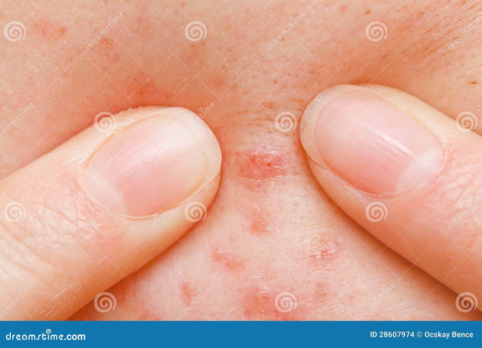 Acne squeezing stock photo. Image of problems, closeup - 28607974