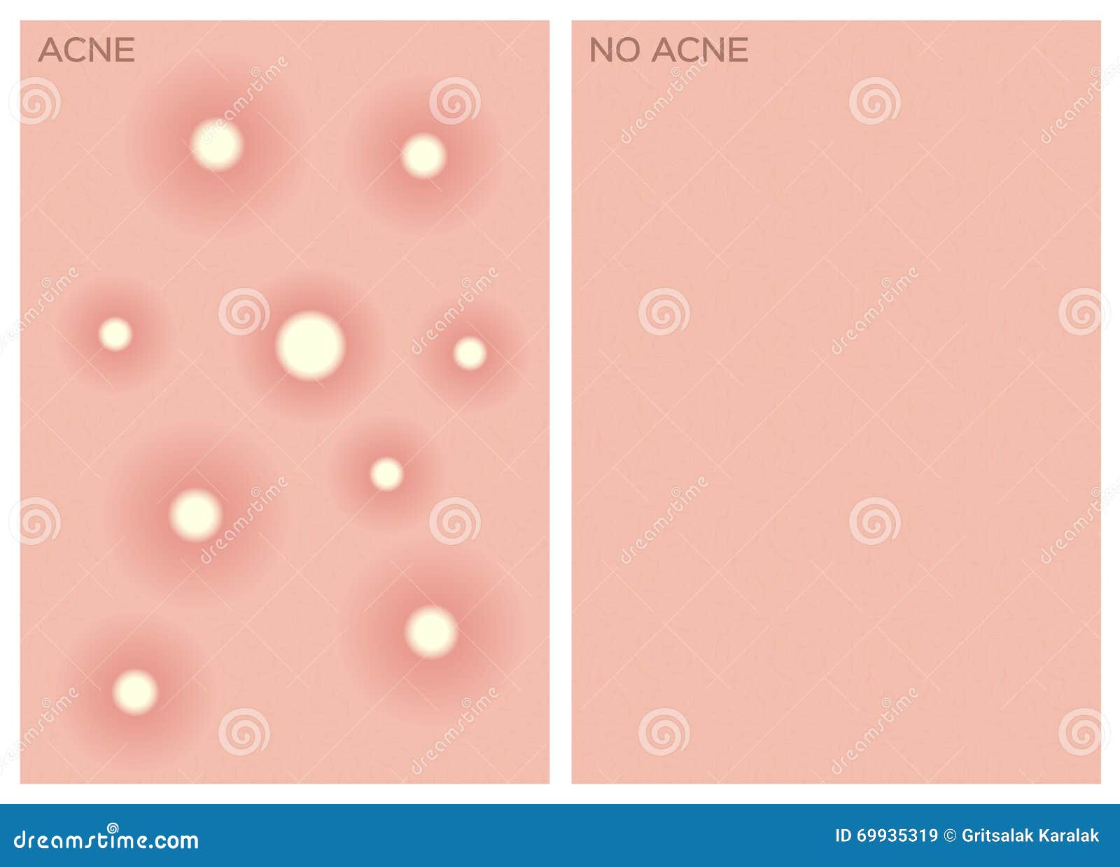 Acne Texture, Pimple. Cosmetic Infographics, Skin Care. Vector ...