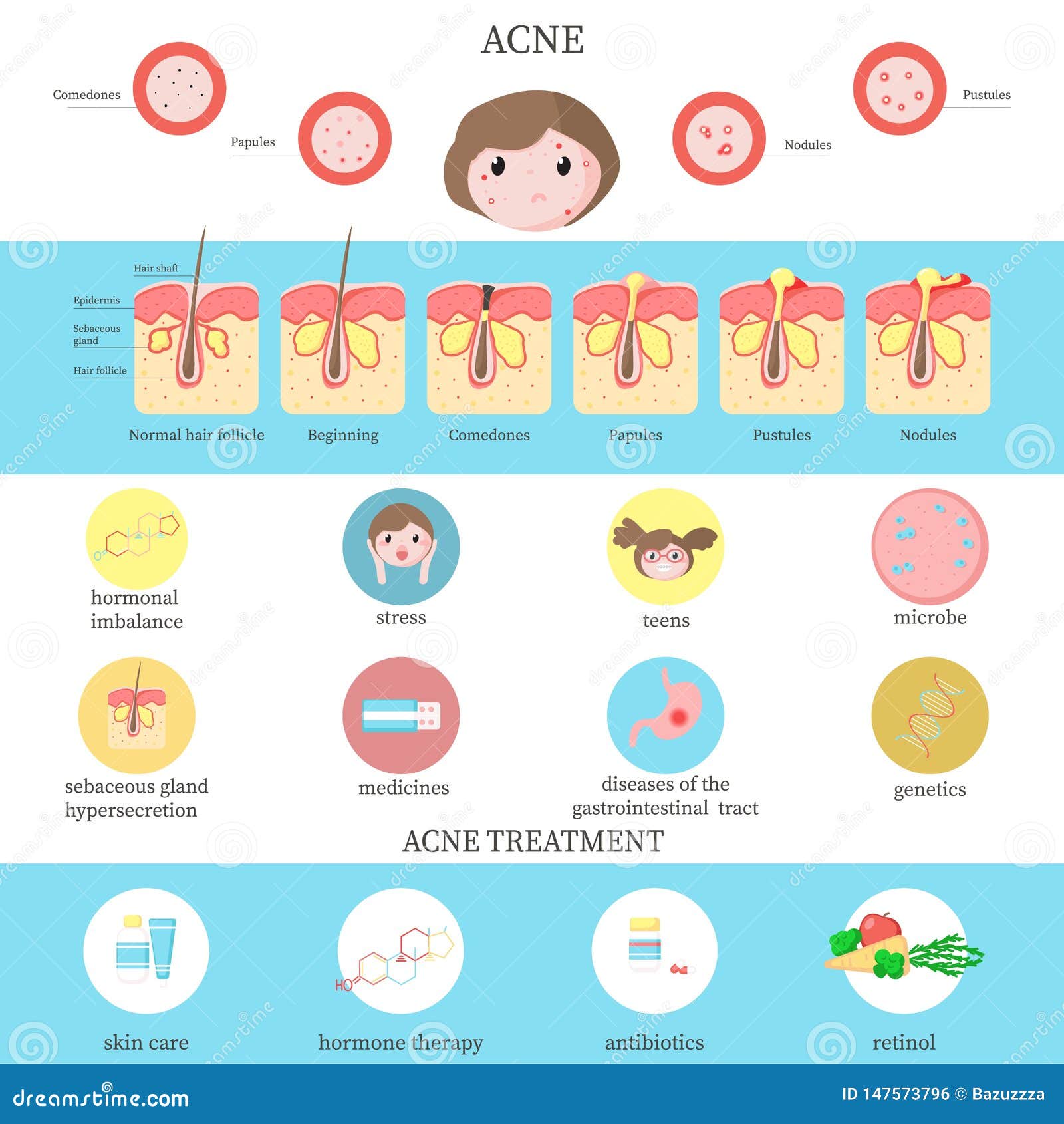 Acne Types Causes And Treatment Infographics Vector Flat Illustration