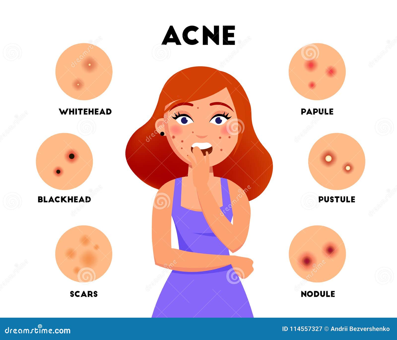Acne Types Infographic Elements Vector Flat Illustration Girl With