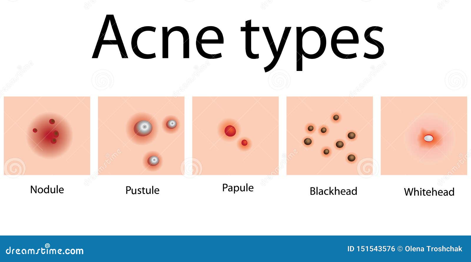 Acne Types Problem Skin Dermatology Stock Vector - Illustration of ...