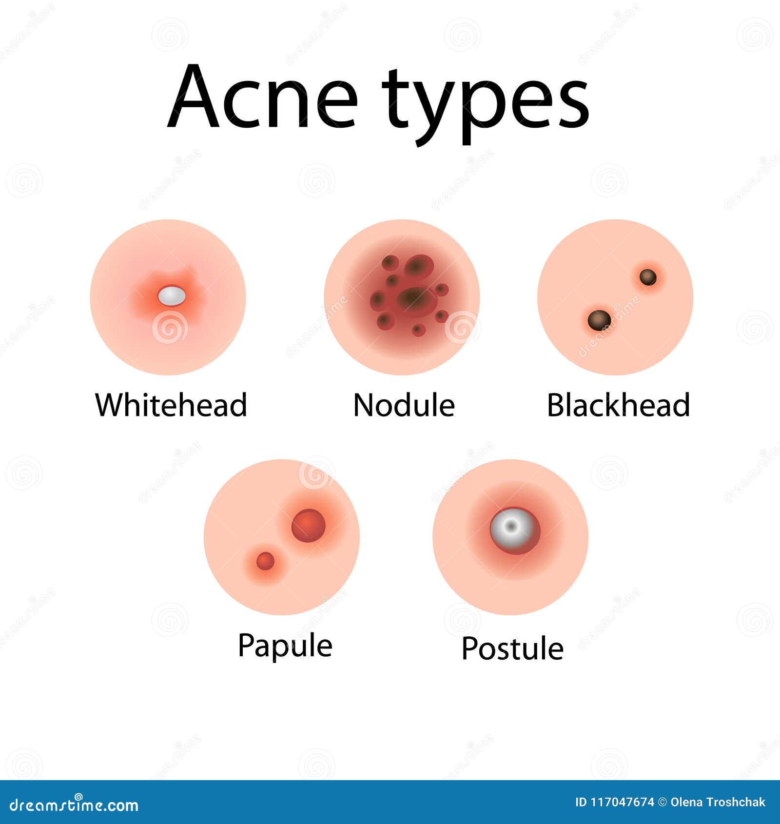 Acne Types Infographic Elements Vector Flat Illustration Girl With