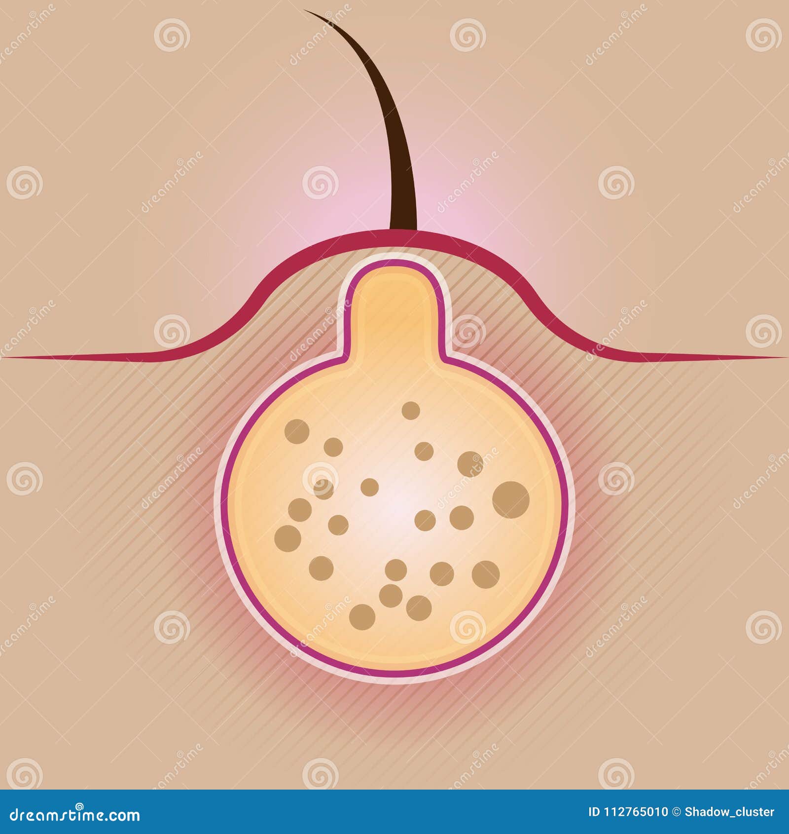Acne Vector Illustration Stock Vector Illustration Of Inflammation