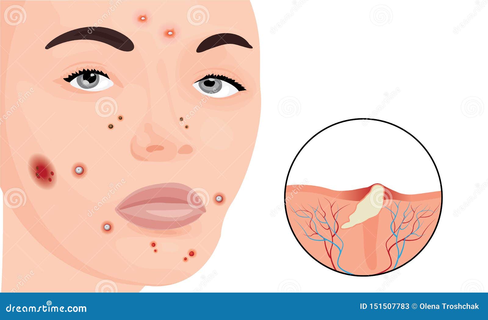 Acne on a woman face stock vector. Illustration of effect - 151507783