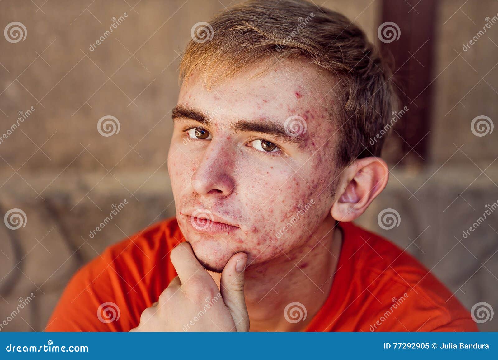 Acne stock image. Image of face, human, demodex, redness - 77292905
