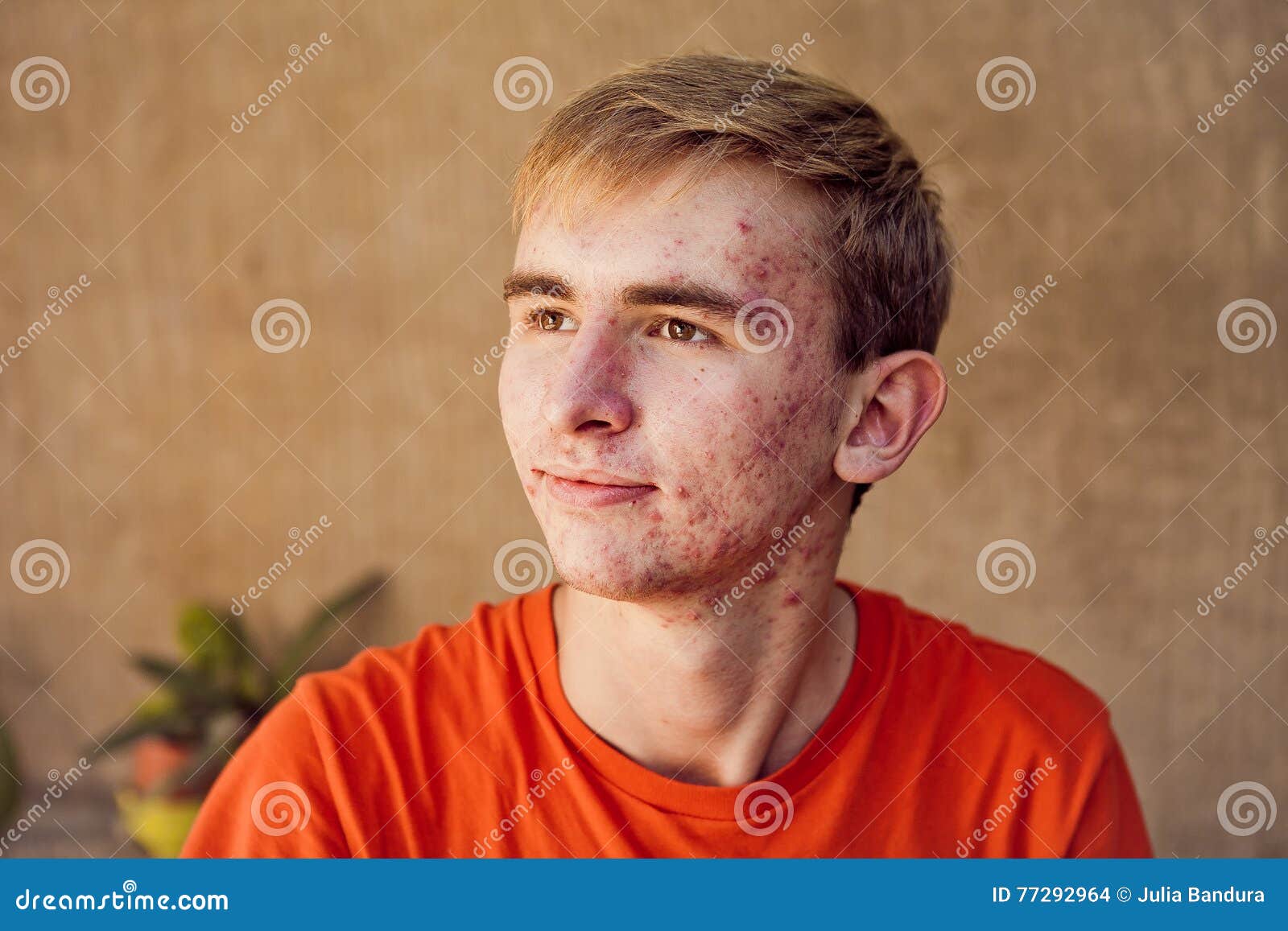 Acne stock photo. Image of redness, acne, inflammation - 77292964