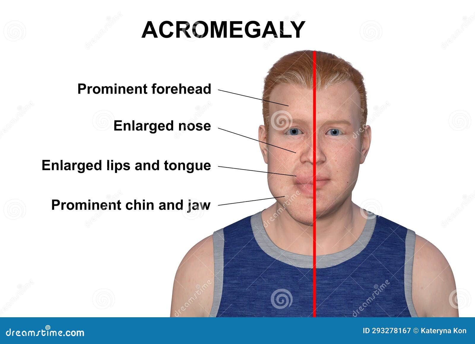 Acromegaly In A Man And The Same Healthy Man 3d Illustration Royalty Free Cartoon