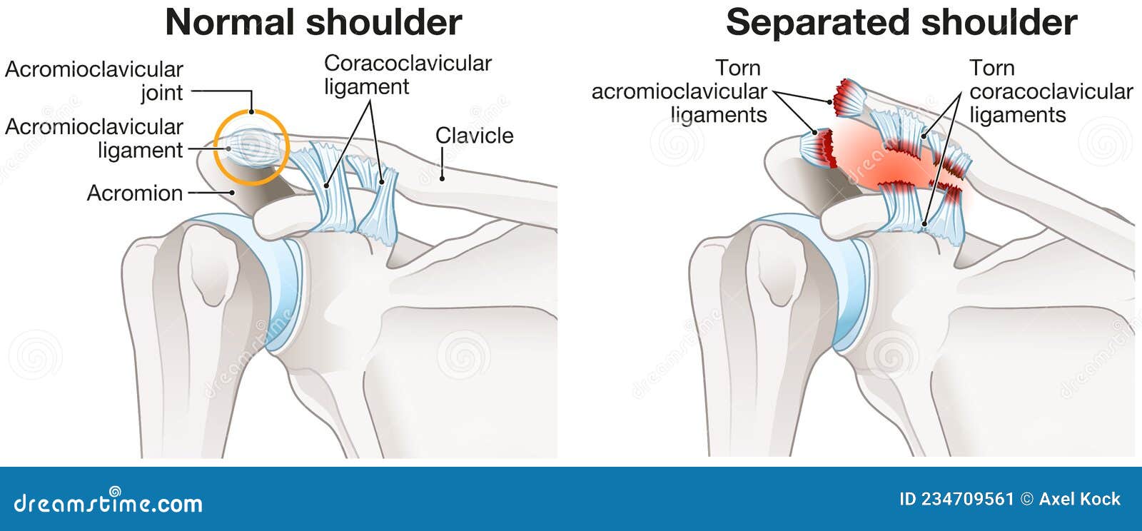 Acromioclavicular Joint Separation or AC Joint Separation or Shoulder ...