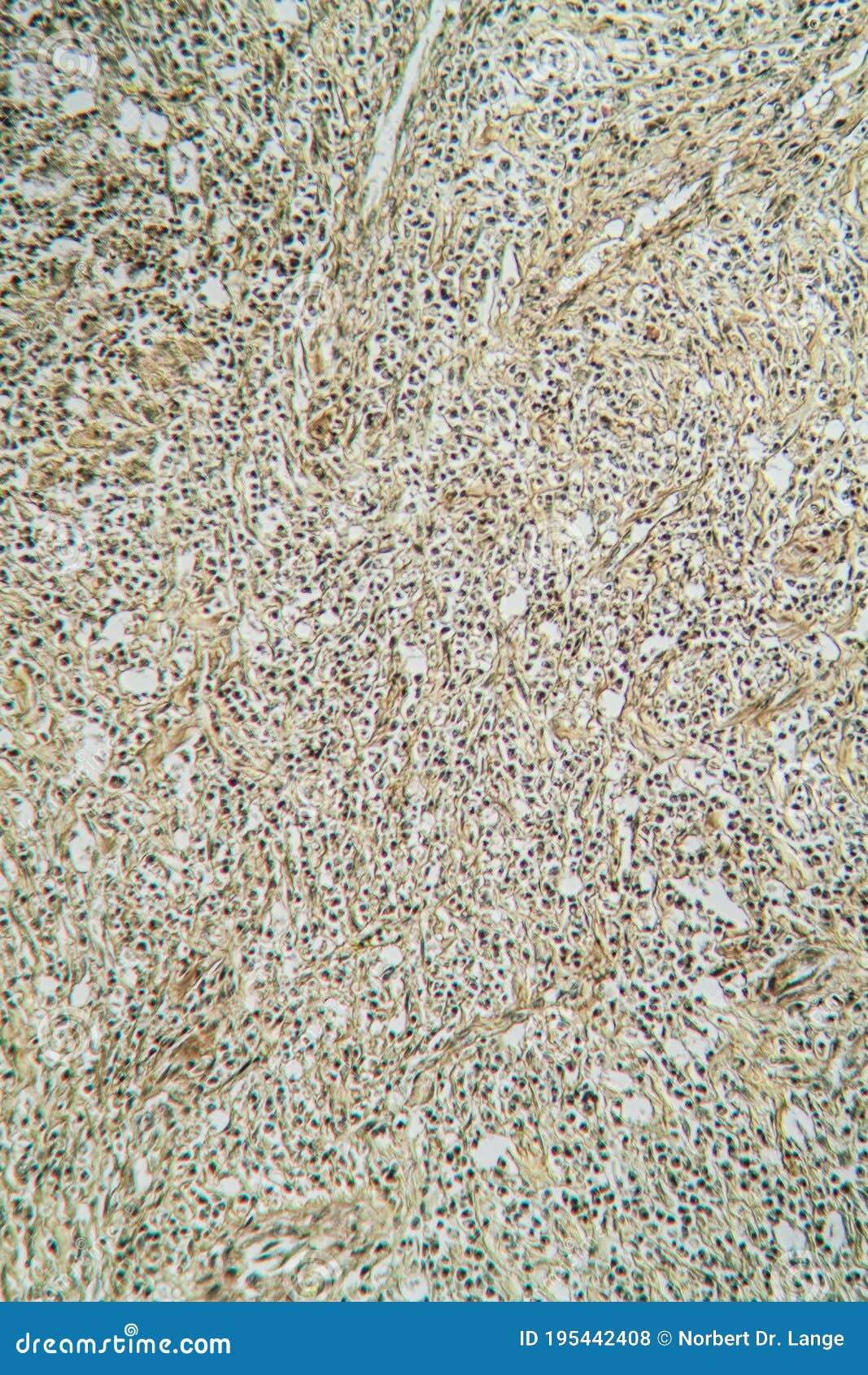 Actinomyces Disease Under the Microscope Stock Photo - Image of cattle ...