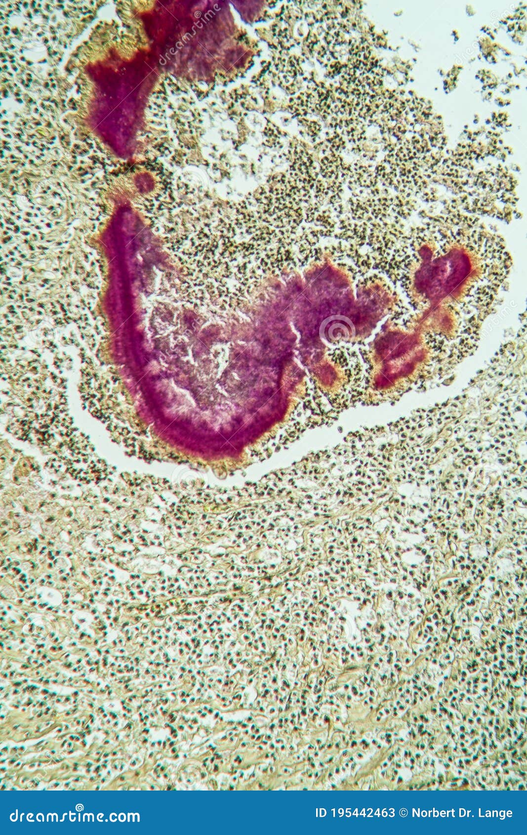 Actinomyces Disease Under the Microscope Stock Image - Image of ...