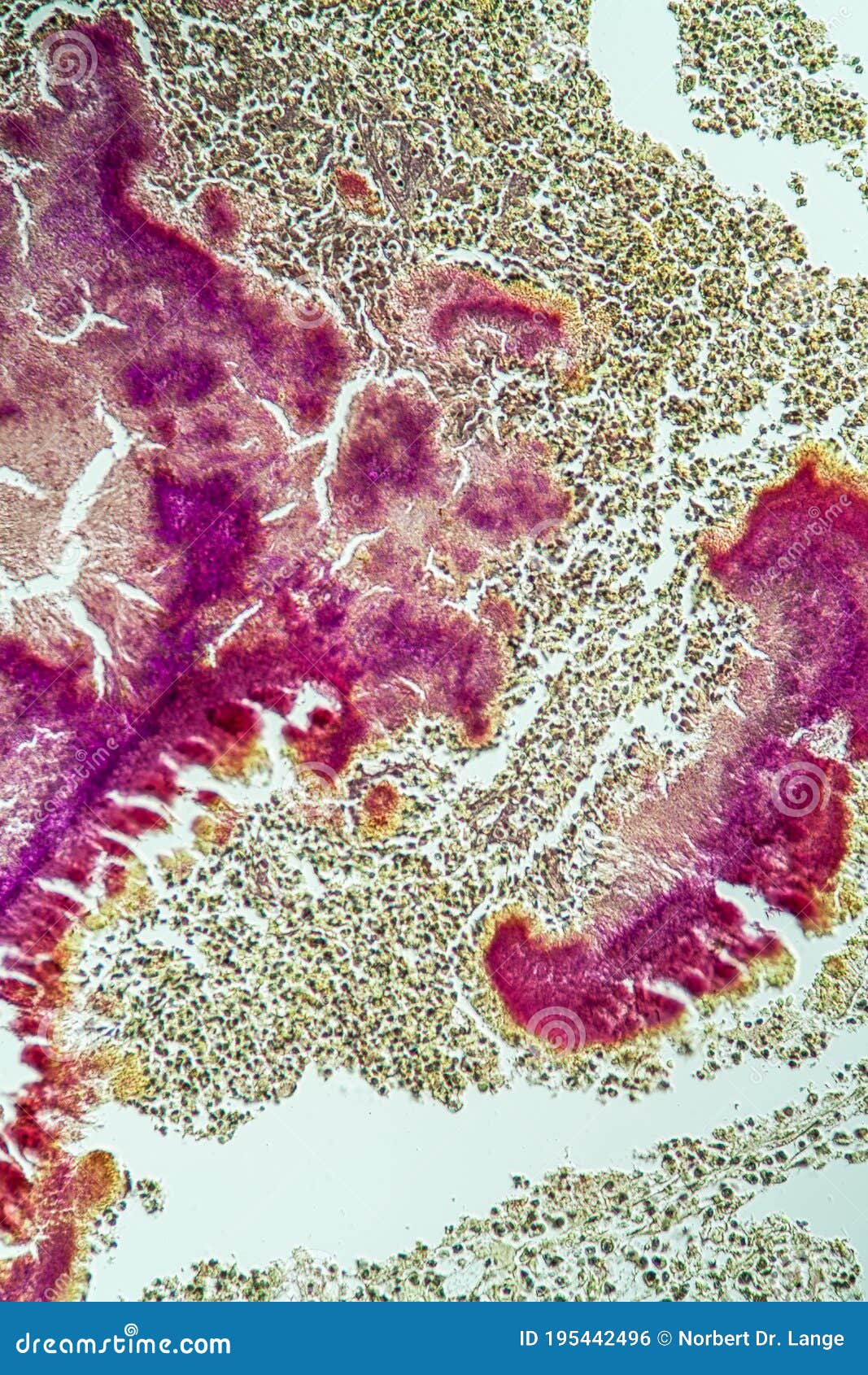 Actinomyces Disease Under the Microscope Stock Photo - Image of ...