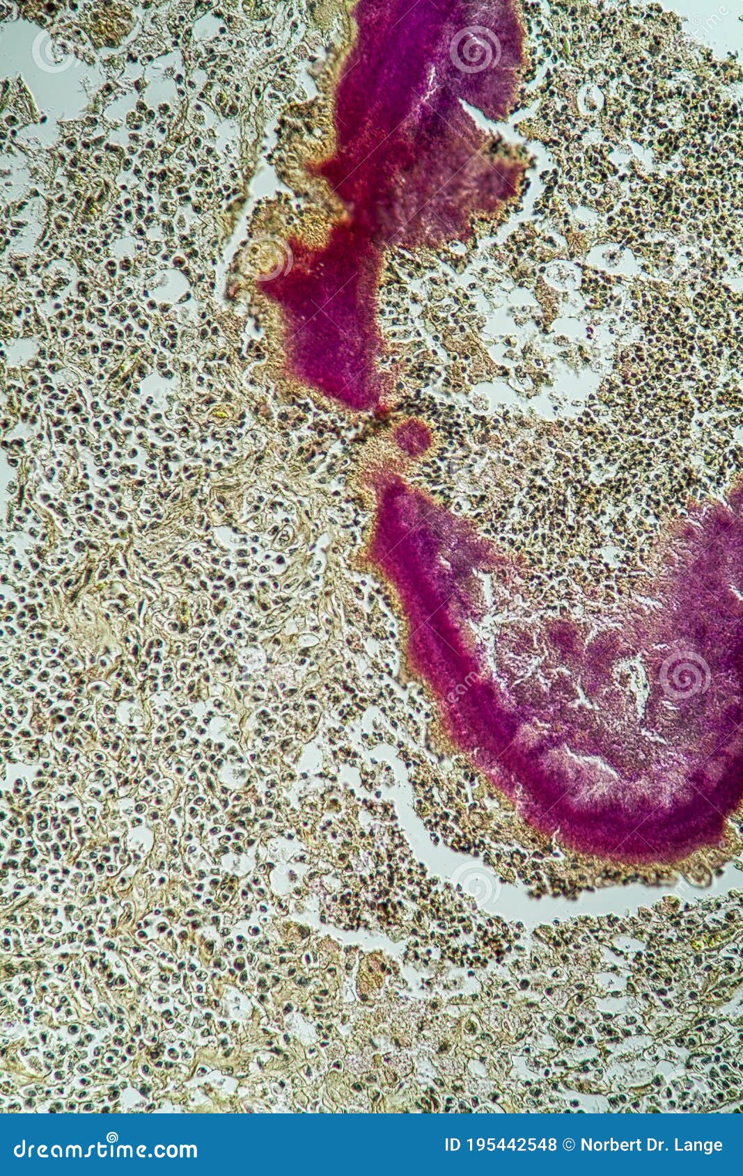 Actinomyces Disease Under the Microscope Stock Photo - Image of macro ...