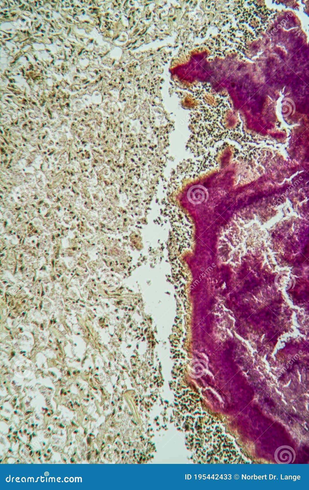 Actinomyces Disease Under The Microscope Royalty-Free Stock Image ...