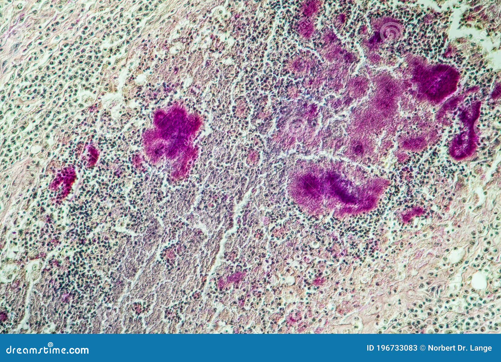 Actinomyces in the Jaw Diseased Tissue Stock Image - Image of ...
