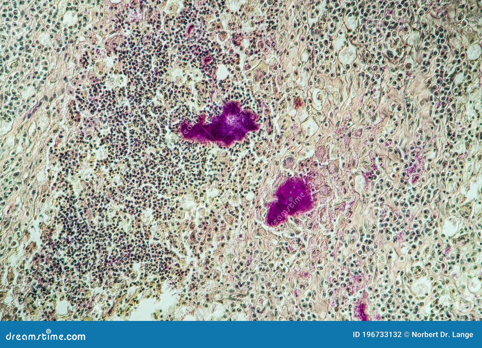 Actinomyces in the Jaw Diseased Tissue Stock Photo - Image of medicine ...