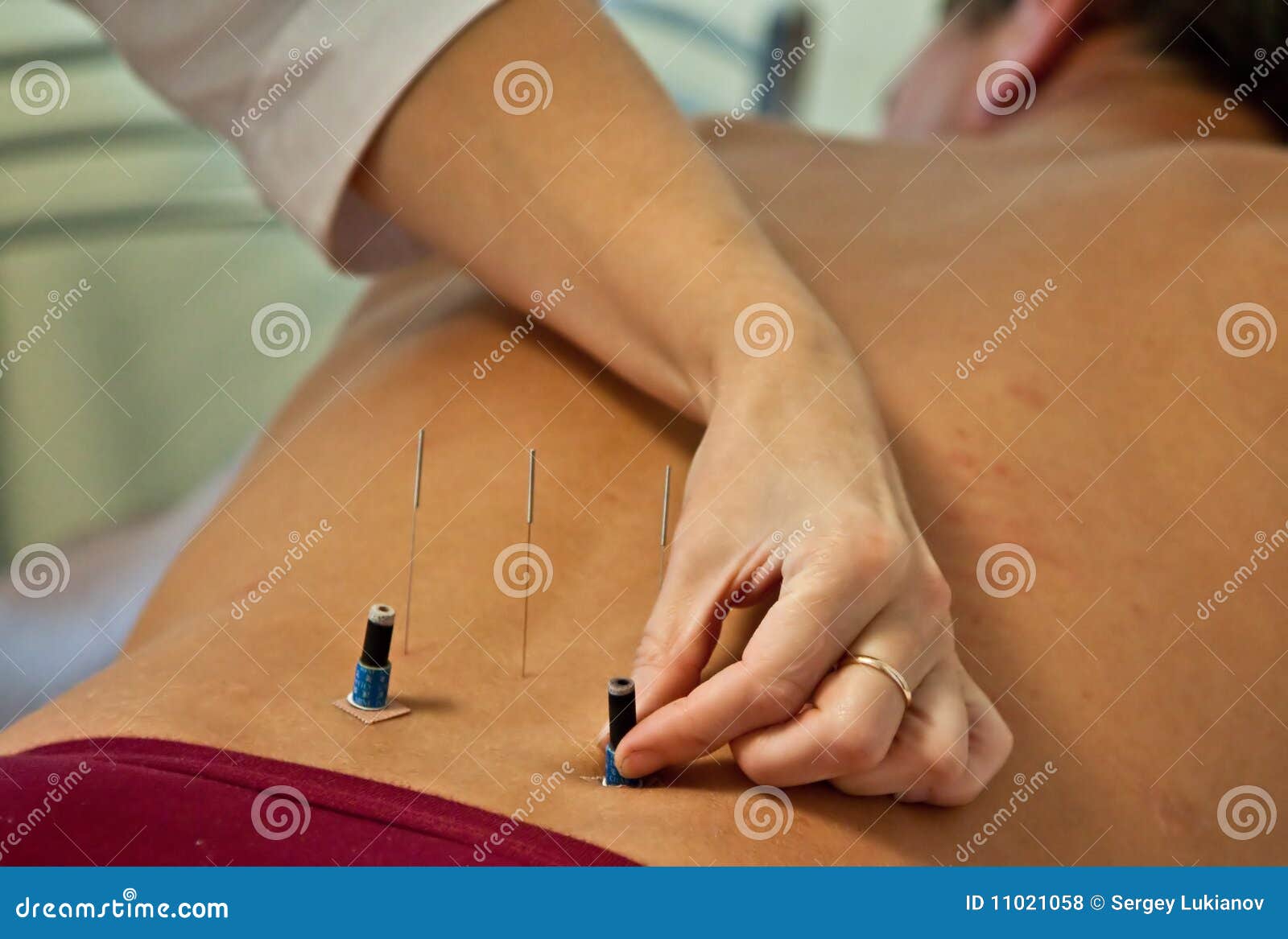Acupuncture stock photo. Image of therapy, complementary - 11021058