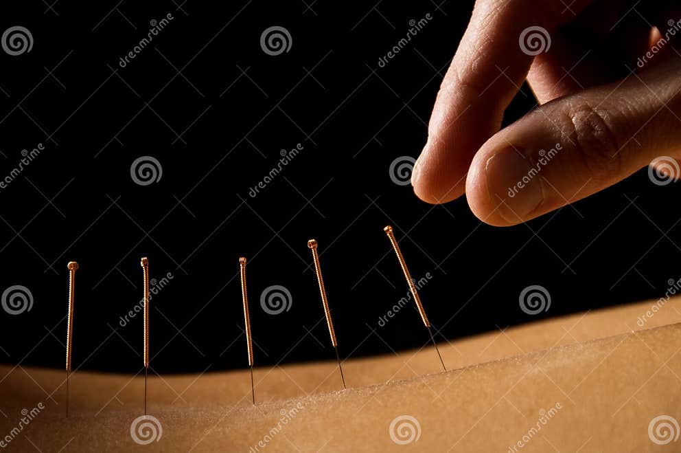 Acupuncture stock photo. Image of closeup, people, lifestyle - 5182288