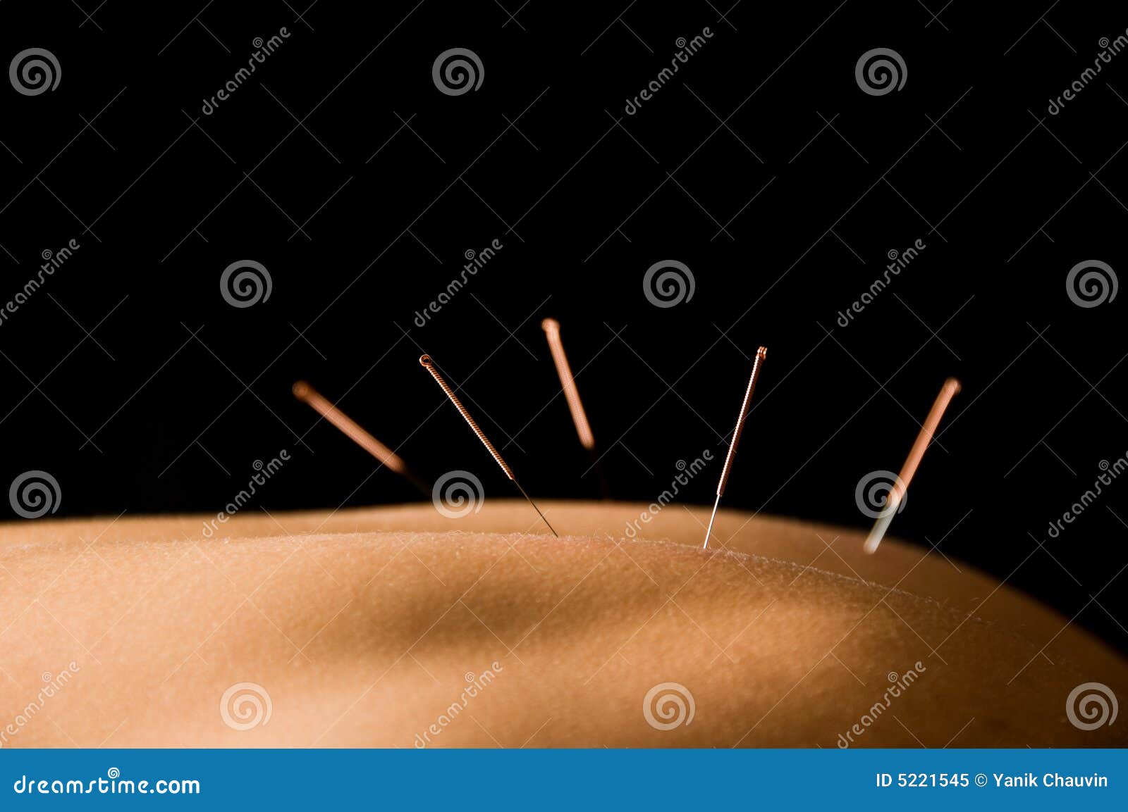 Acupuncture stock image. Image of attractive, isolated - 5221545
