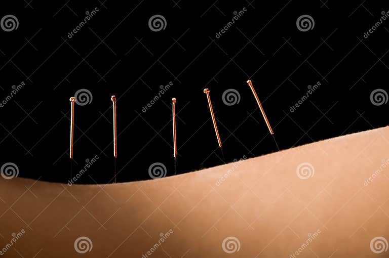 Acupuncture stock image. Image of beauty, massage, lady - 5221565