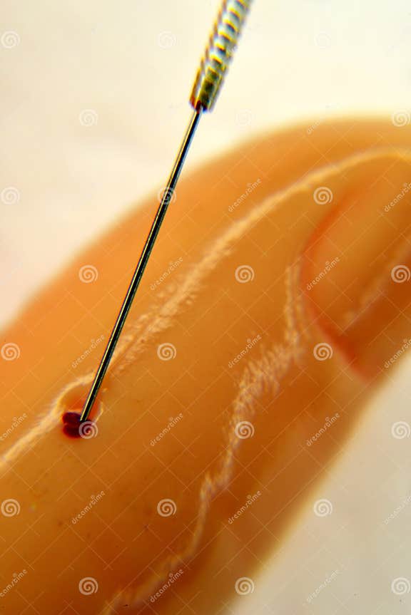 Acupuncture Demonstration on Hand Model Stock Photo - Image of model ...