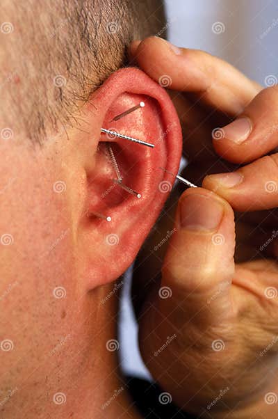 Acupuncture in Ear stock photo. Image of cleansing, holistic - 3351098